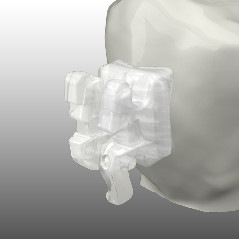 LightForce Braces - Heritage Orthodontics